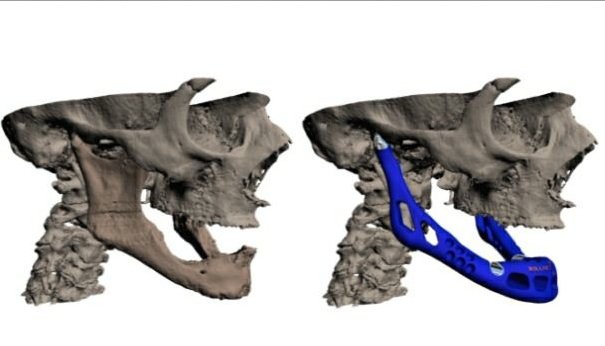 The Future of Medicine: Fake Muscles and 3D Printed Implants – Stories ...